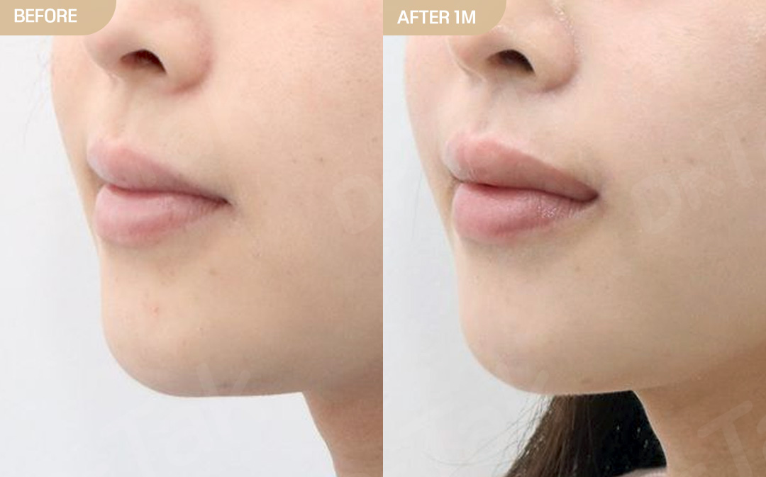 Downturned Mouth Corner Correction : Before & After Gallery | Dr. Tak ...