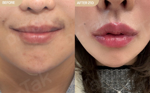 What Are Keyhole Lips? Korea's Expert Guide to Natural Lip Enhancement ...