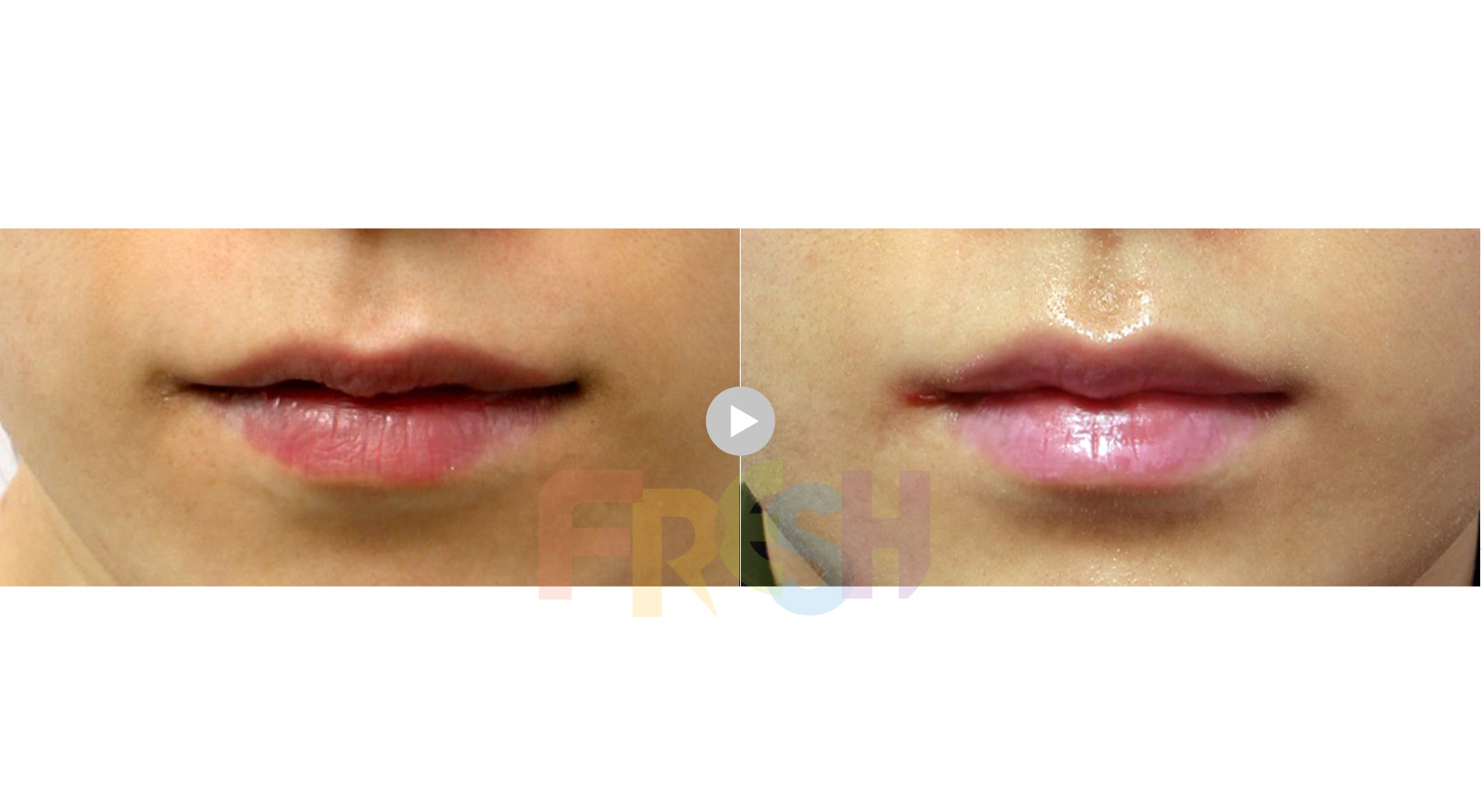 [Petit Surgery]Filler_Lip&Lip corner : Fresh Plastic Surgery / Petit ...