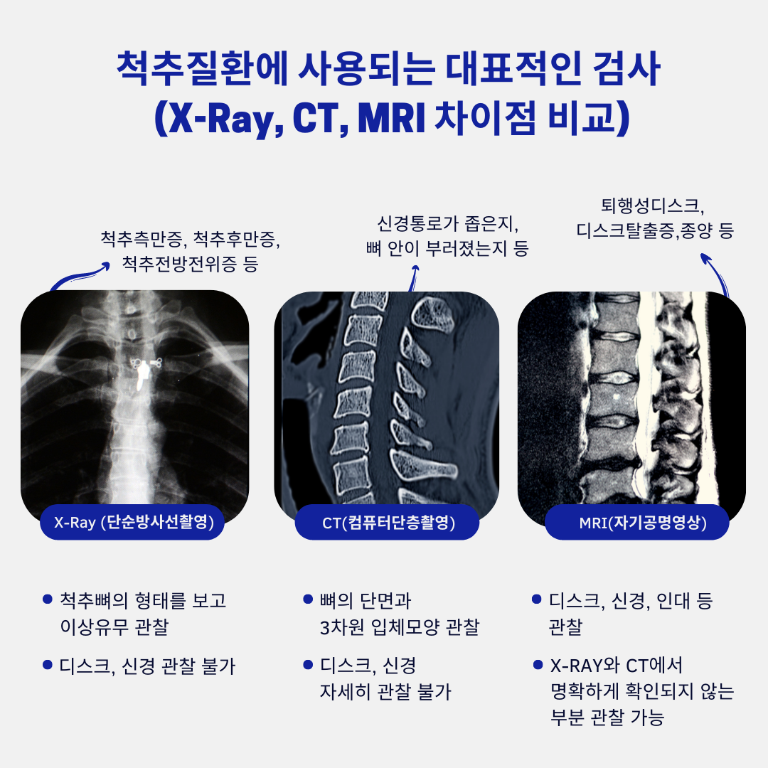 [22-07-26] 척추질환 대표 검사(X-Ray,CT,MRI) 차이점 비교 : 참바른병원