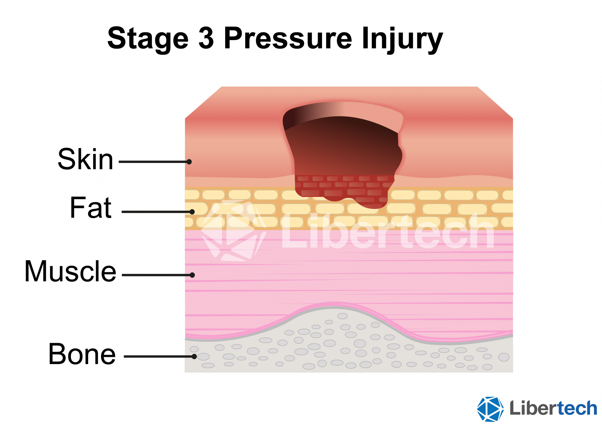 Understanding And Addressing Pressure Injuries A Comprehensive Guide Understanding And Addressing Pressure Injuries A Comprehensive Guide