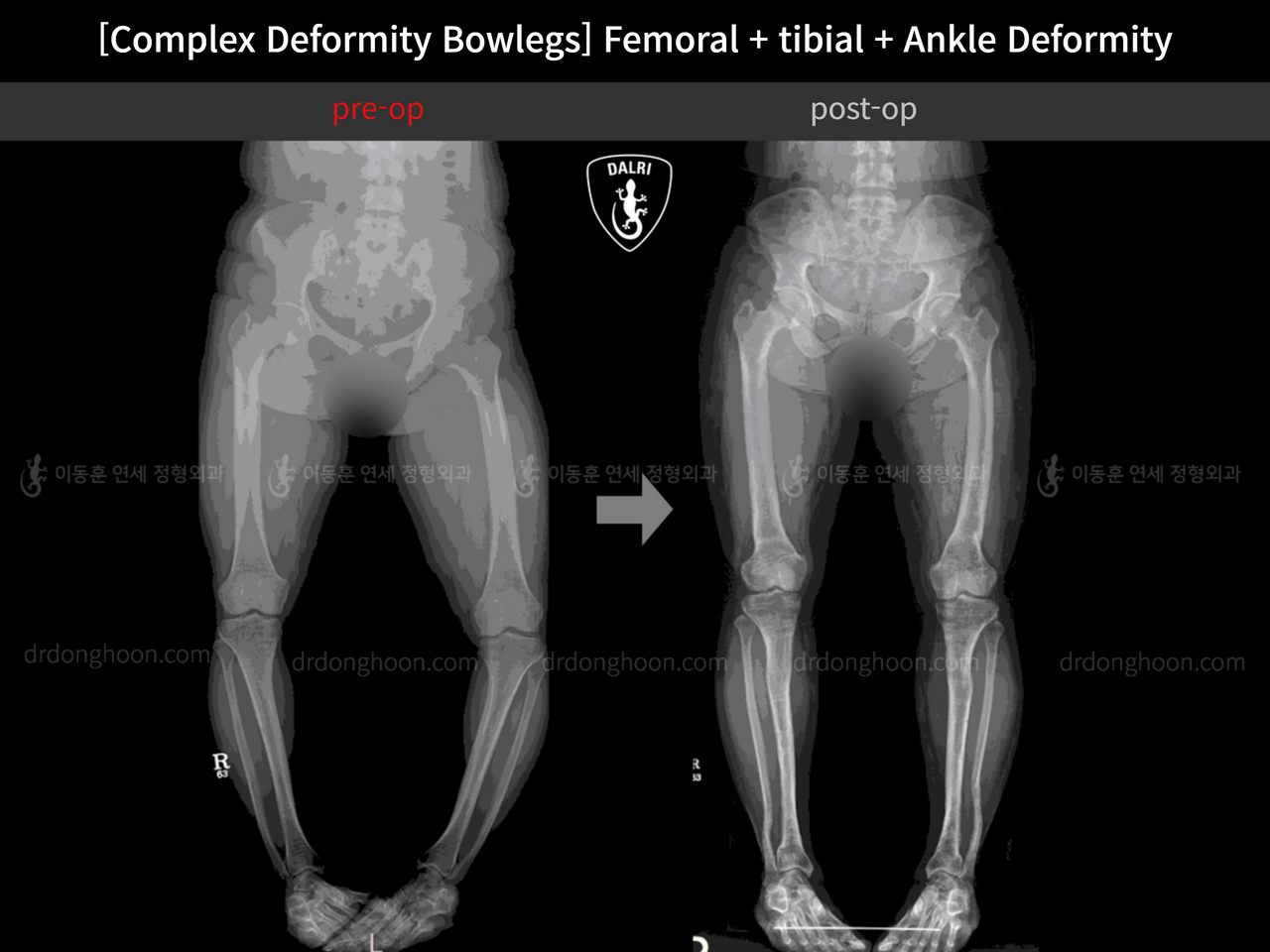 [Complex Deformity Bowlegs] Femoral + tibial + Ankle Deformity : Complex Deformity