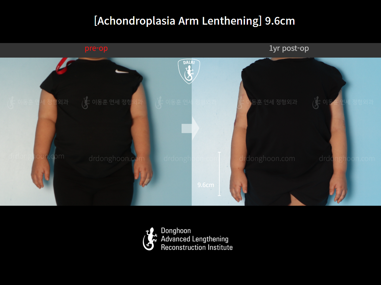 [Achondroplasia Arm Lenthening] 9.6cm : Arm Lengthening