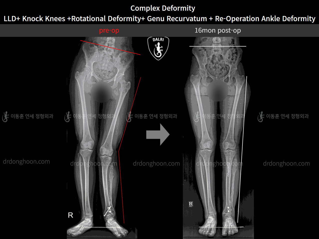 Tibial Lengthening + Knock Knees + Genu Recurvatum + Re-Operation Ankle ...