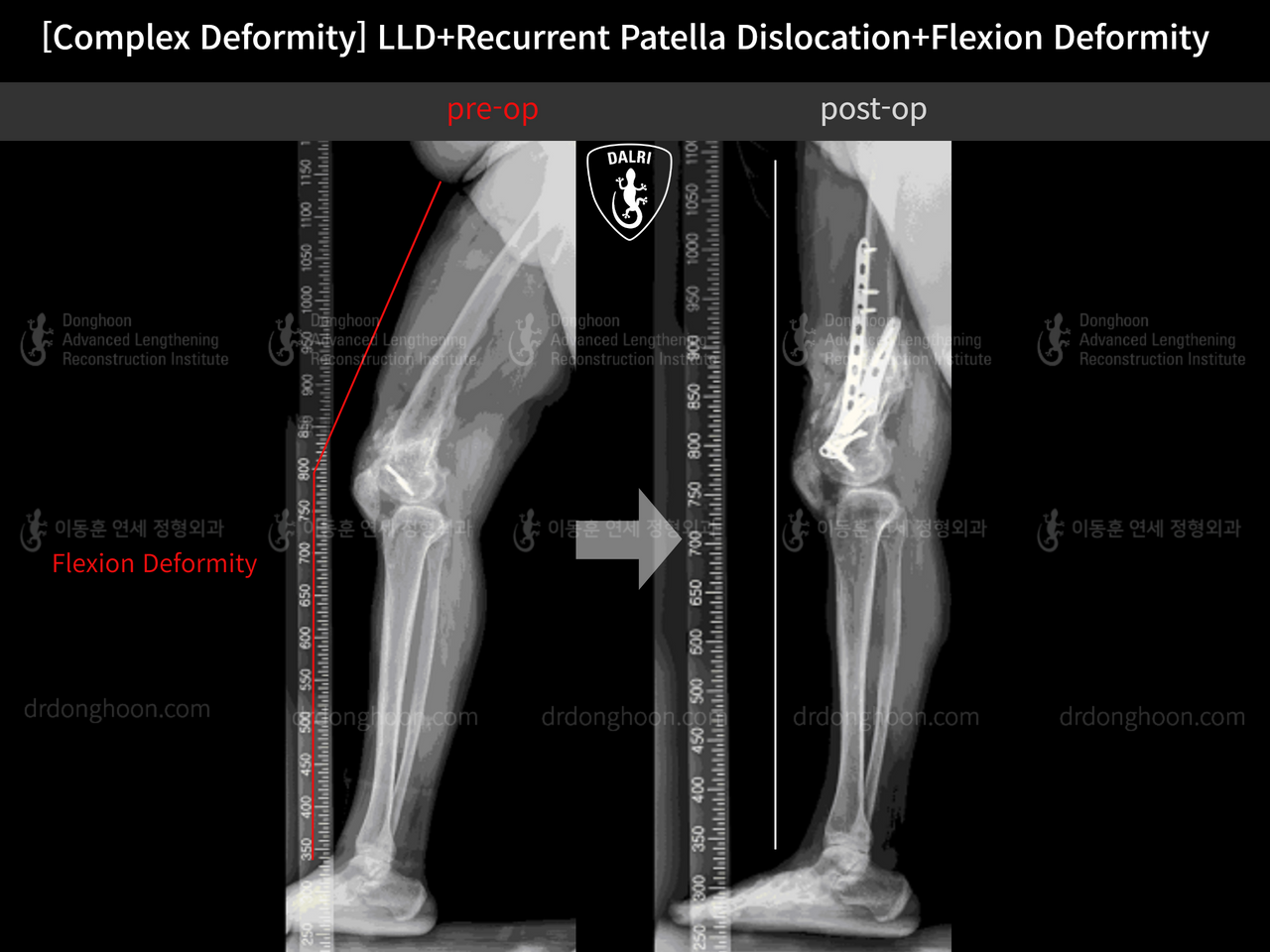 [Complex Deformity] LLD+Recurrent Patella Dislocation+Flexion Deformity ...