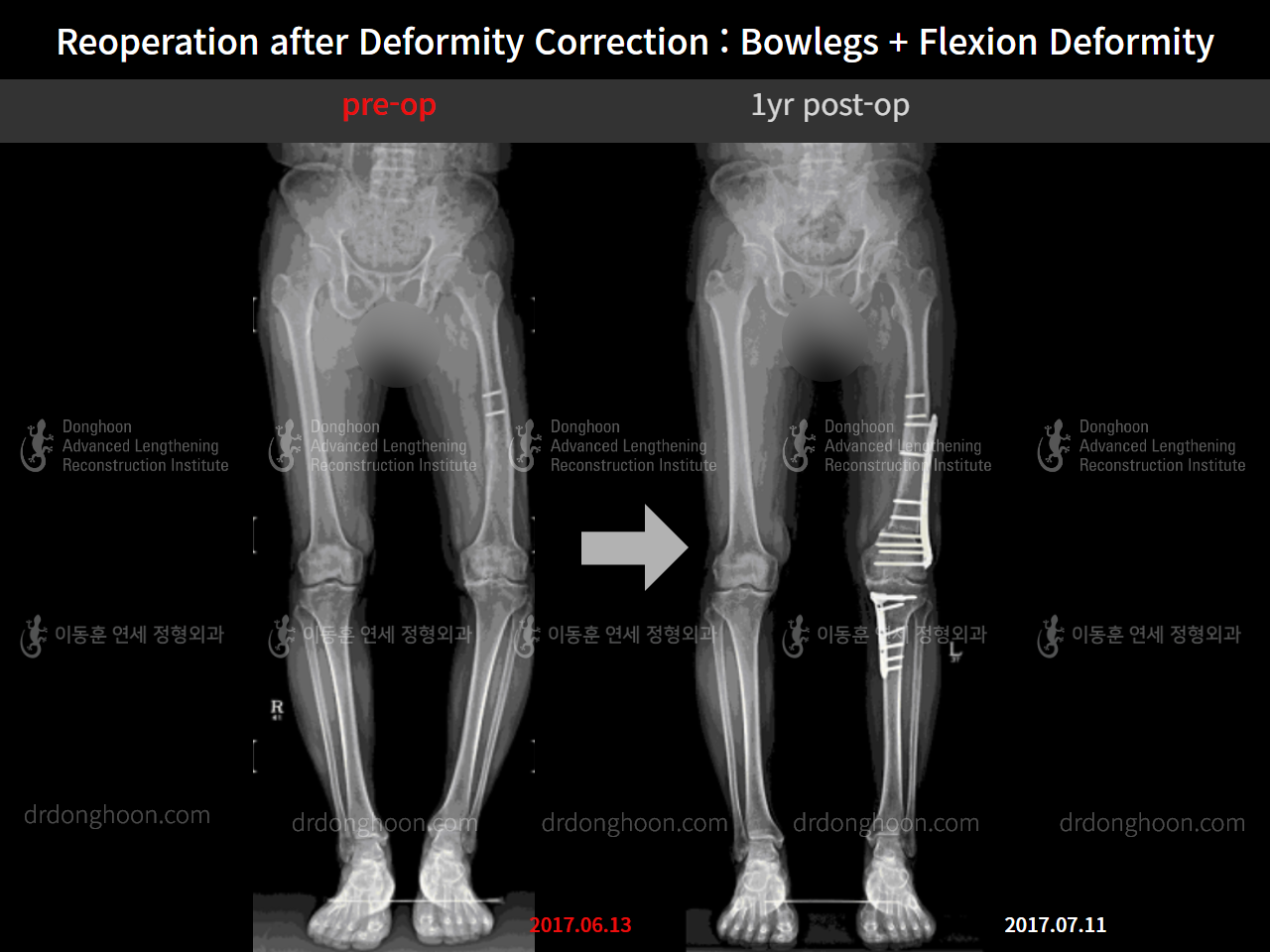 Reoperation after Deformity Correction : Bowlegs + Flexion Deformity ...