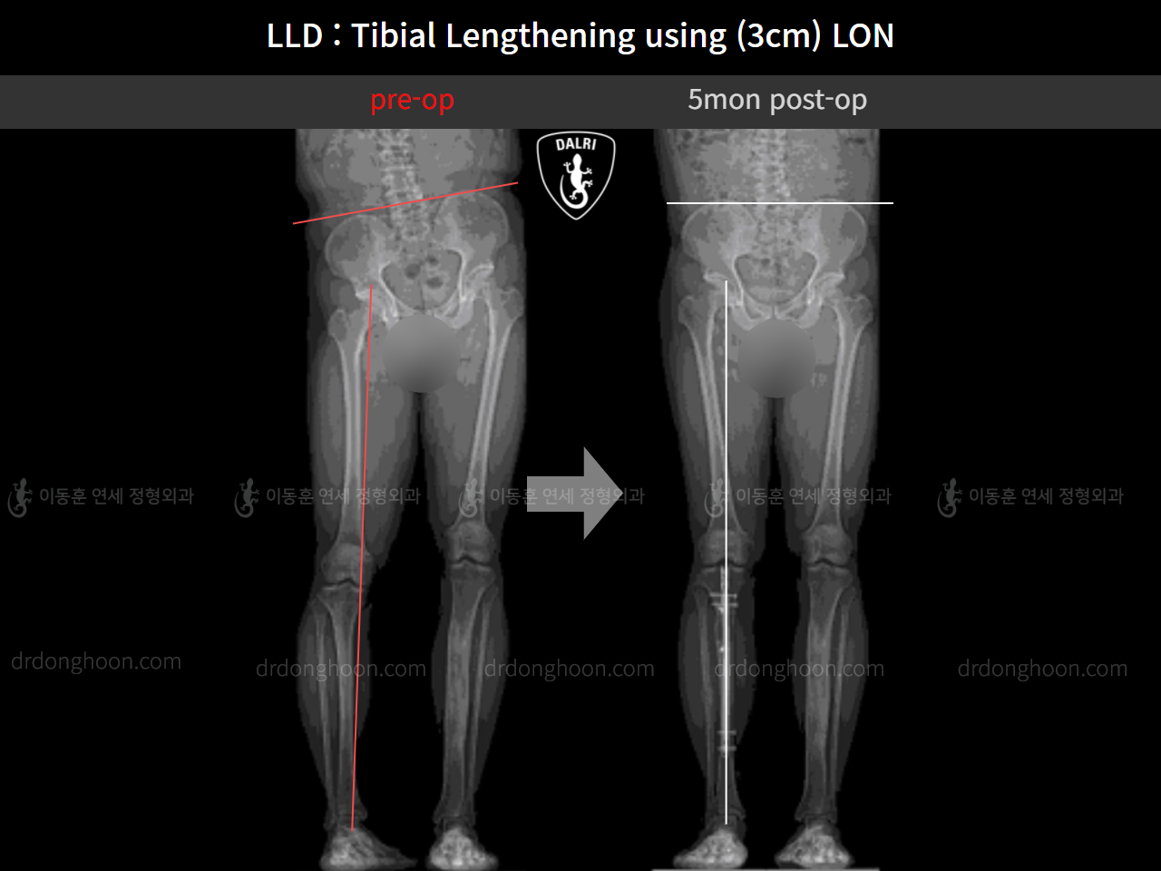 LLD : Tibial Lengthening using (3cm) LON : 5mon post-op : Adult LLD