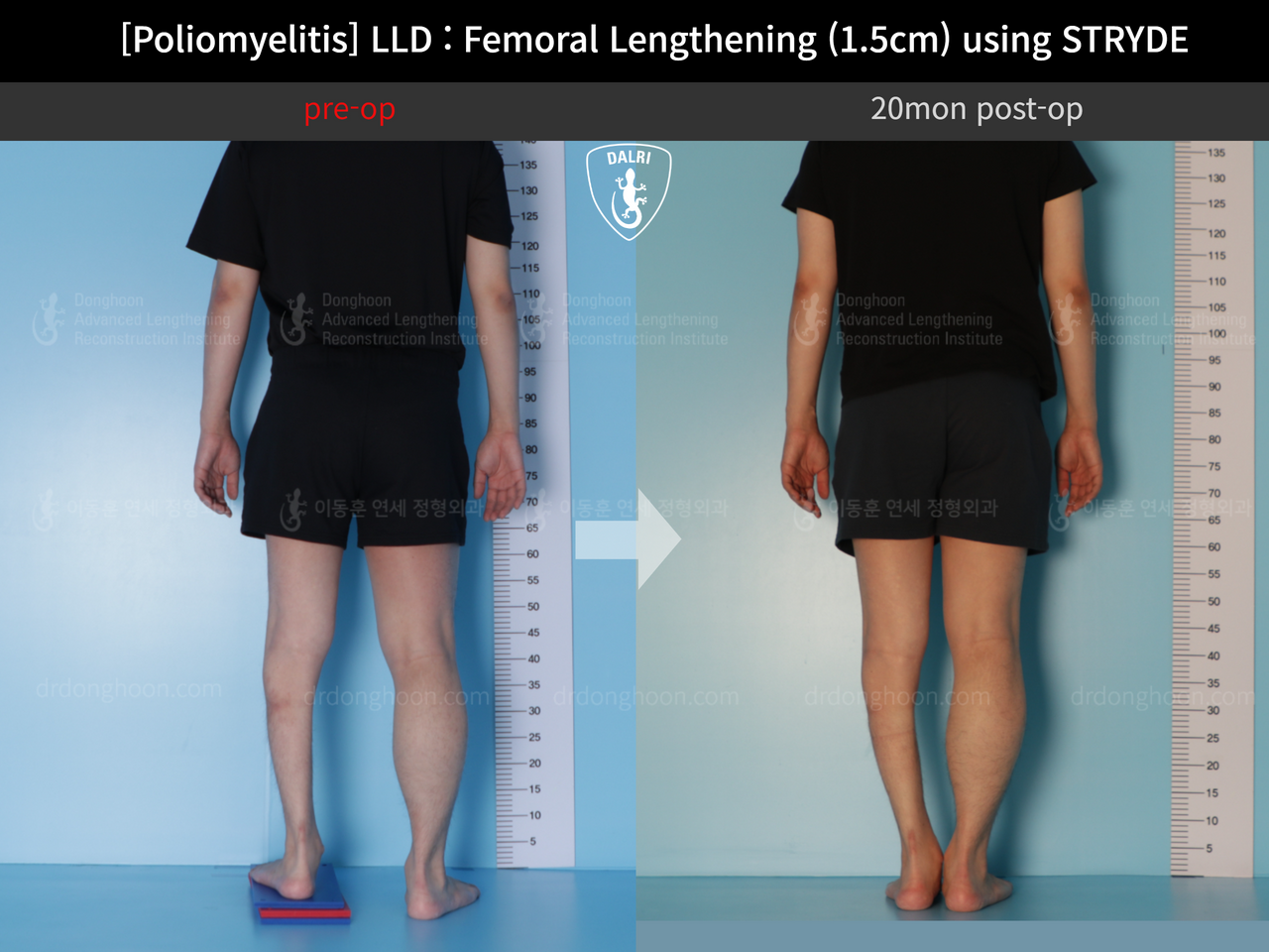 [Poliomyelitis] LLD : Femoral Lengthening (1.5cm) using STRYDE ...