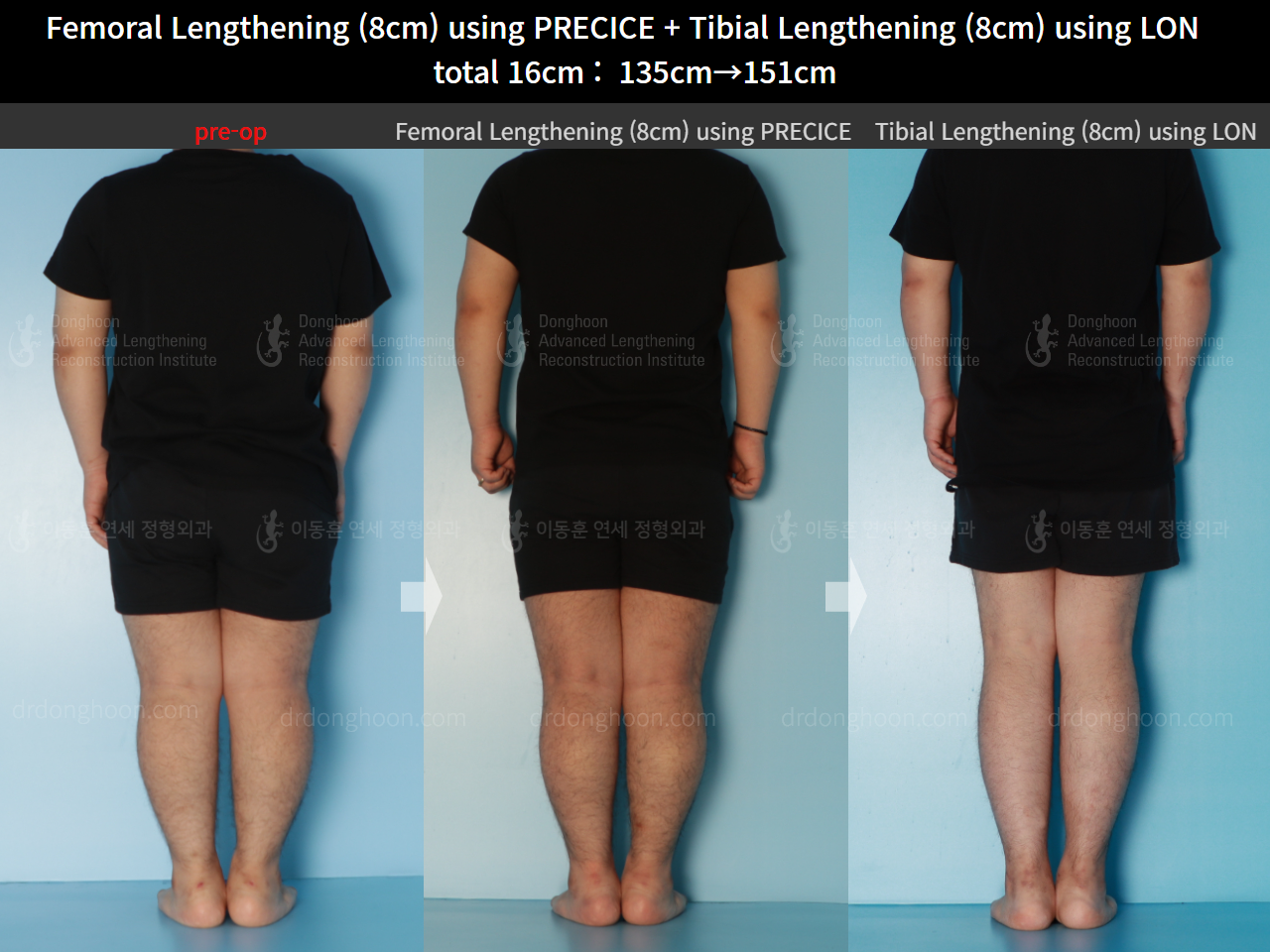 Femoral Lengthening (8cm) using PRECICE + Tibial Lengthening (8cm) using LON : total 16cm ...
