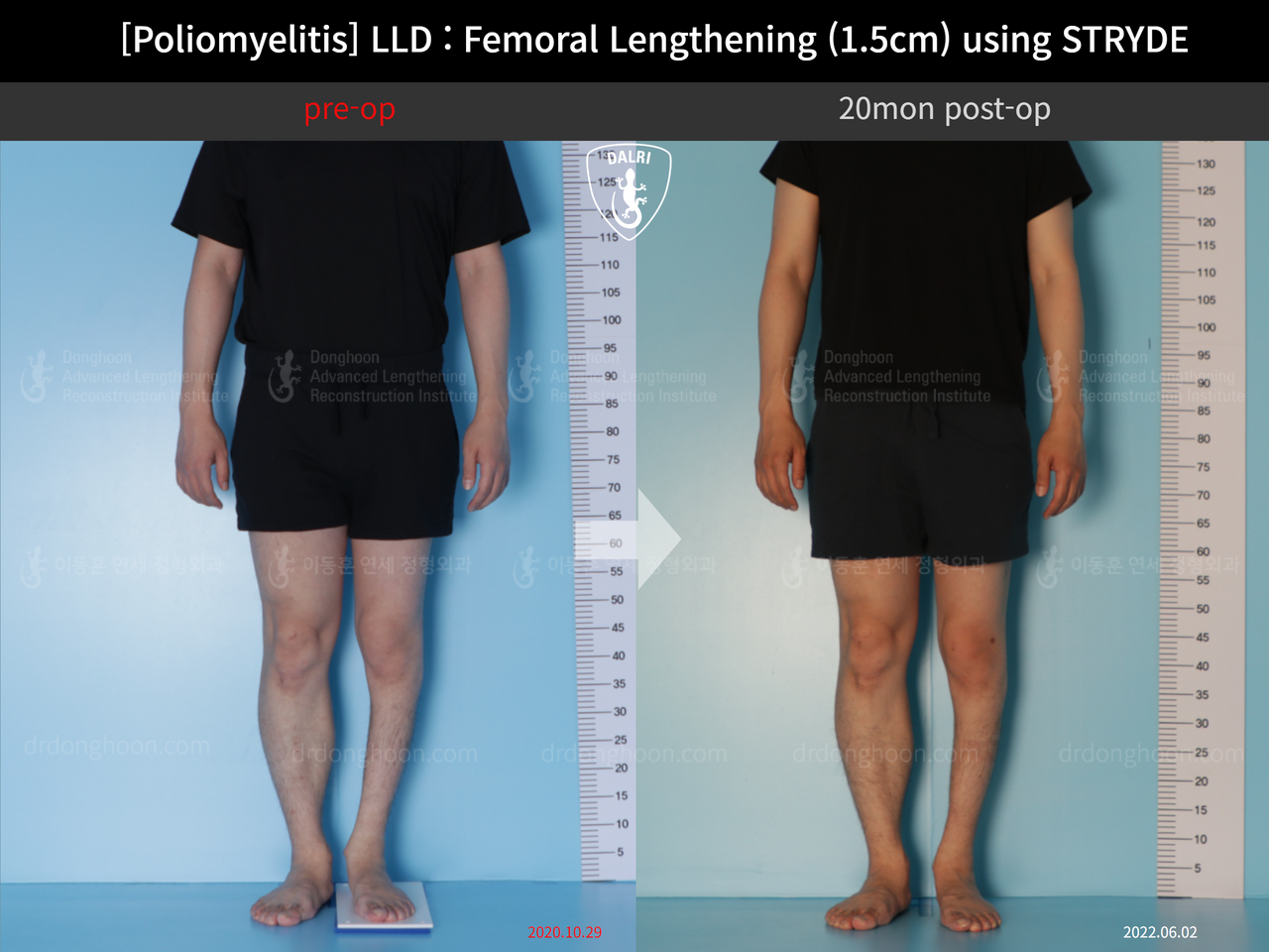 [Poliomyelitis] LLD : Femoral Lengthening (1.5cm) using STRYDE ...
