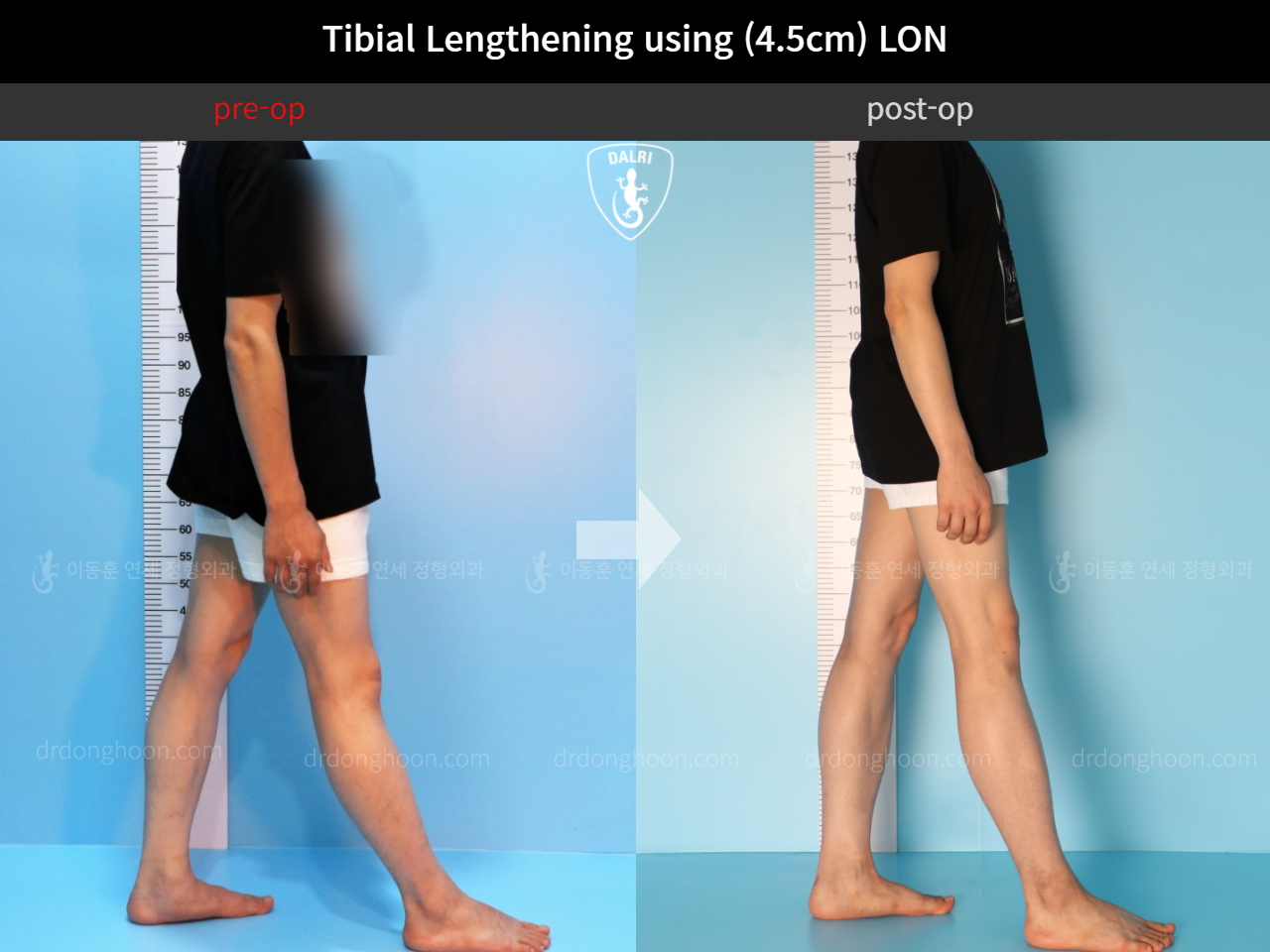 Tibial Lengthening using (4.5cm) LON : DALRI before & after