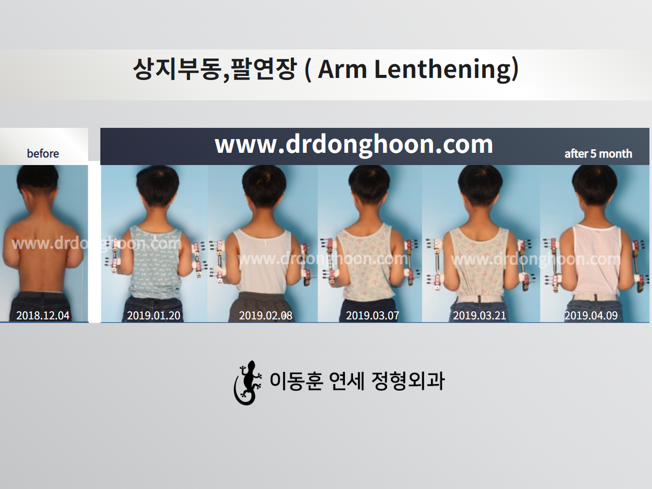 Arm Lengthening : Arm Lengthening