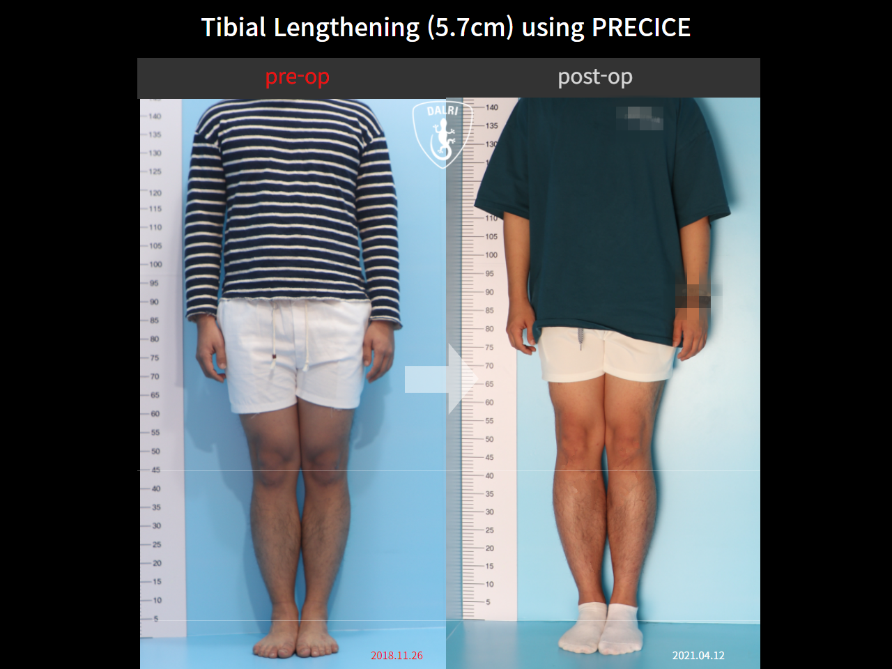 Tibial Lengthening (5.7cm) using PRECICE : CLL PRECICE