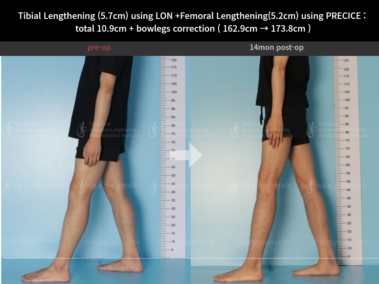 Tibial Lengthening (5.7cm) using LON +Femoral Lengthening(5.2cm) using ...