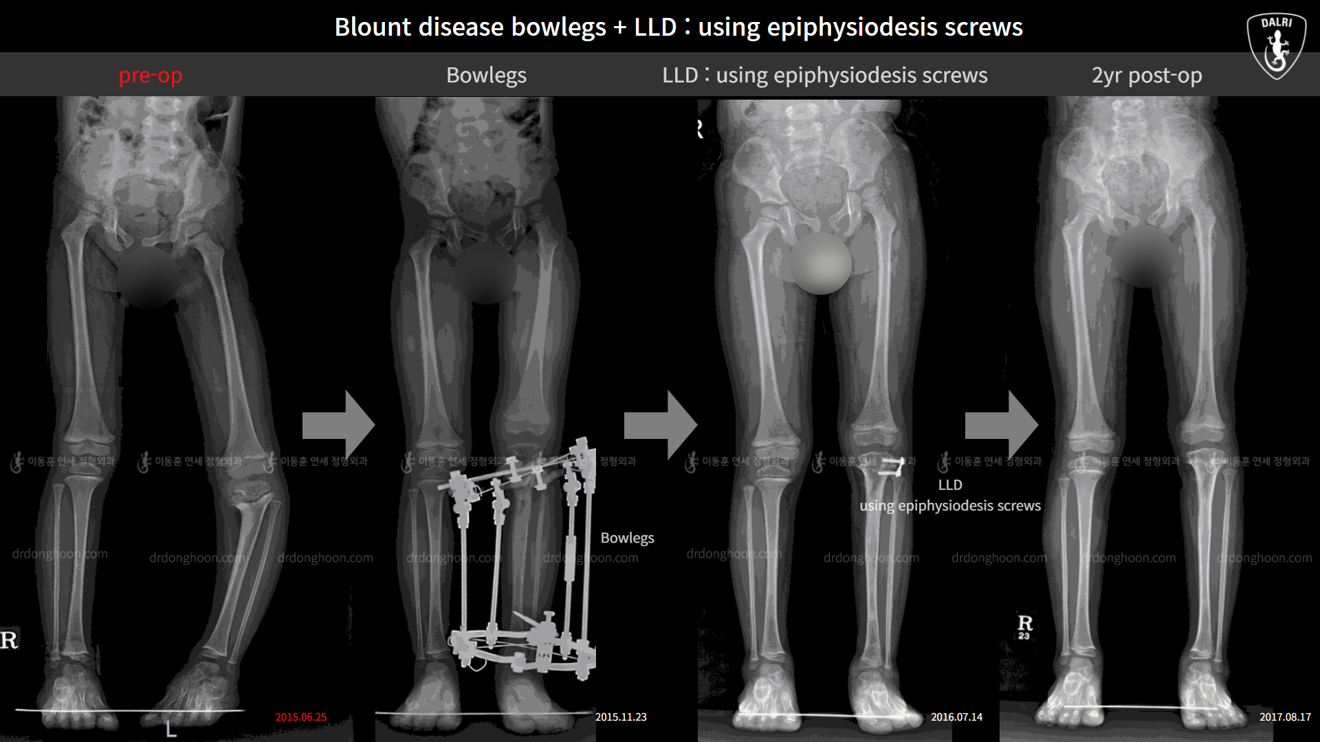 Blount disease bowlegs + LLD : using epiphysiodesis screws : Pediatric ...