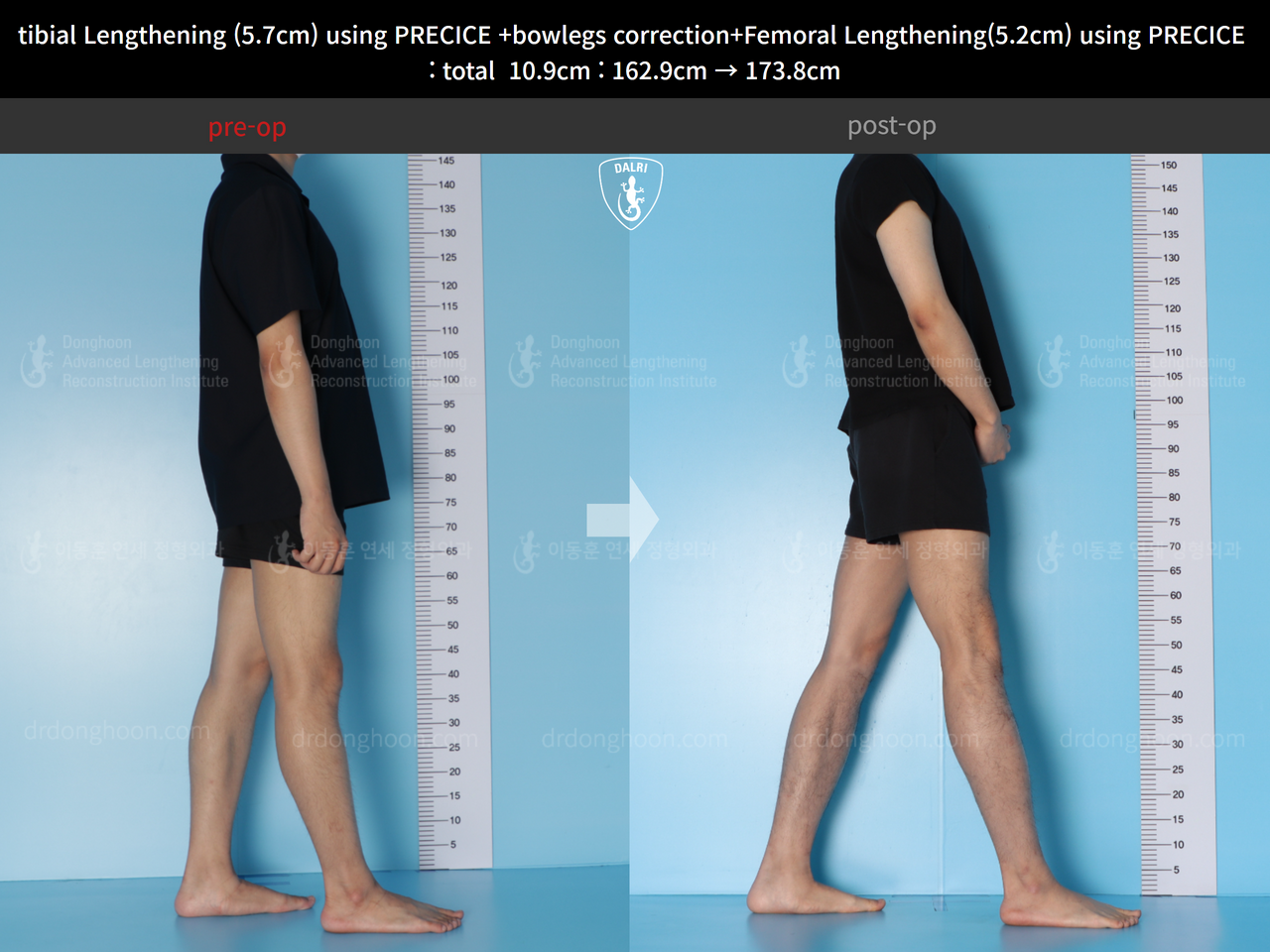 tibial Lengthening (5.7cm) using PRECICE +bowlegs correction+Femoral Lengthening(5.2cm) using ...