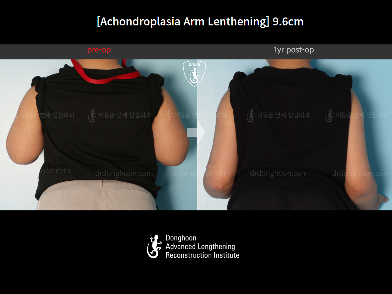 [Achondroplasia Arm Lenthening] 9.6cm : Arm Lengthening