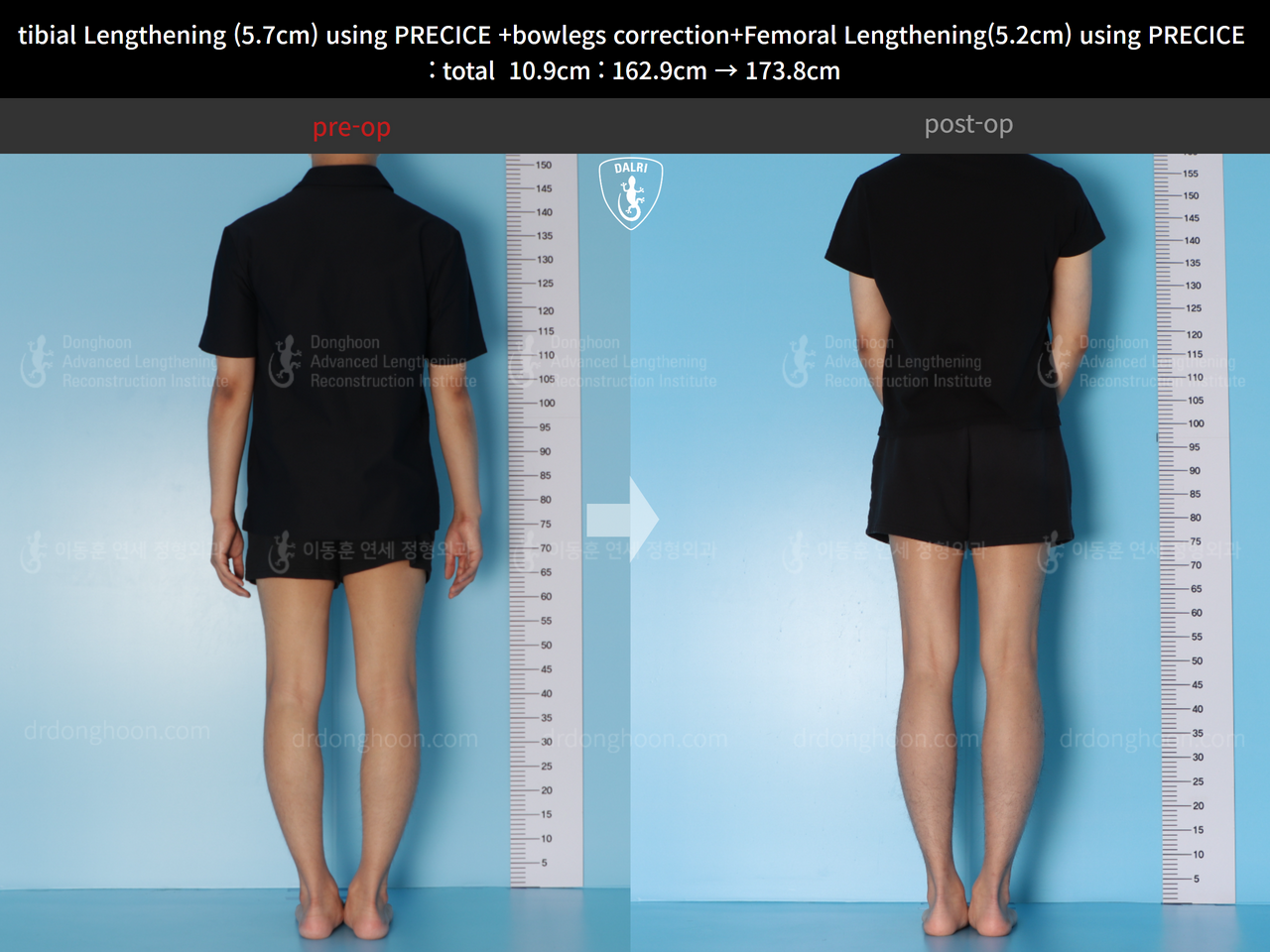 tibial Lengthening (5.7cm) using PRECICE +bowlegs correction+Femoral Lengthening(5.2cm) using ...