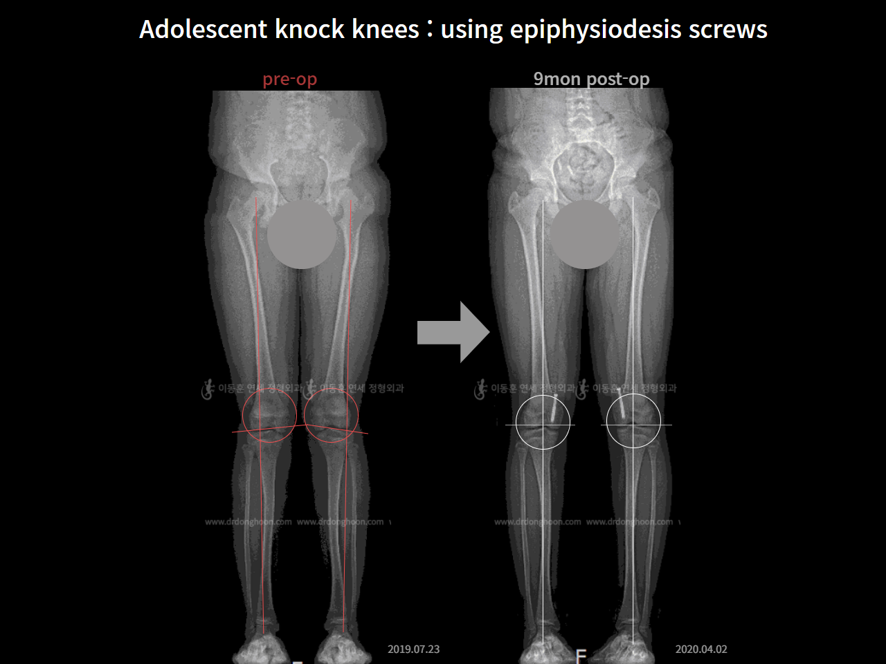 Adolescent knock knees : using epiphysiodesis screws : Pediatric ...
