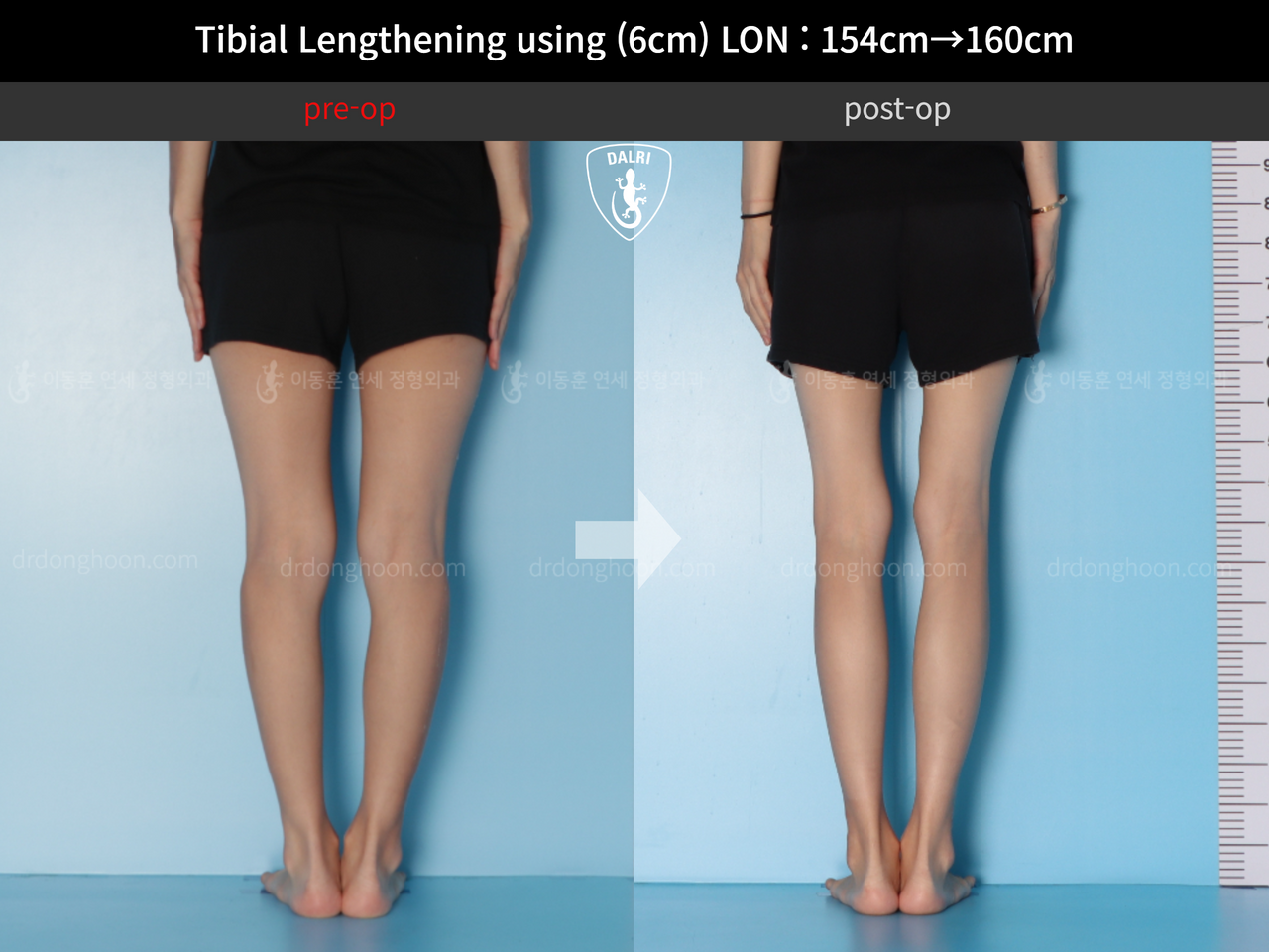 Tibial Lengthening using (6cm) LON : 154cm→160cm : DALRI before & after
