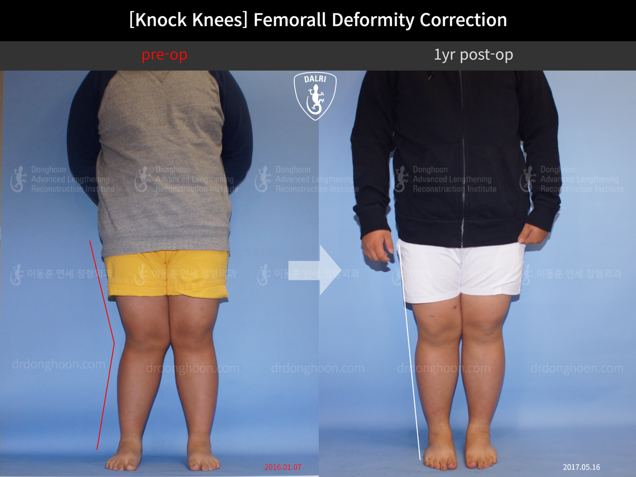 [Knock Knees] Femorall Deformity Correction : Adult knock knees