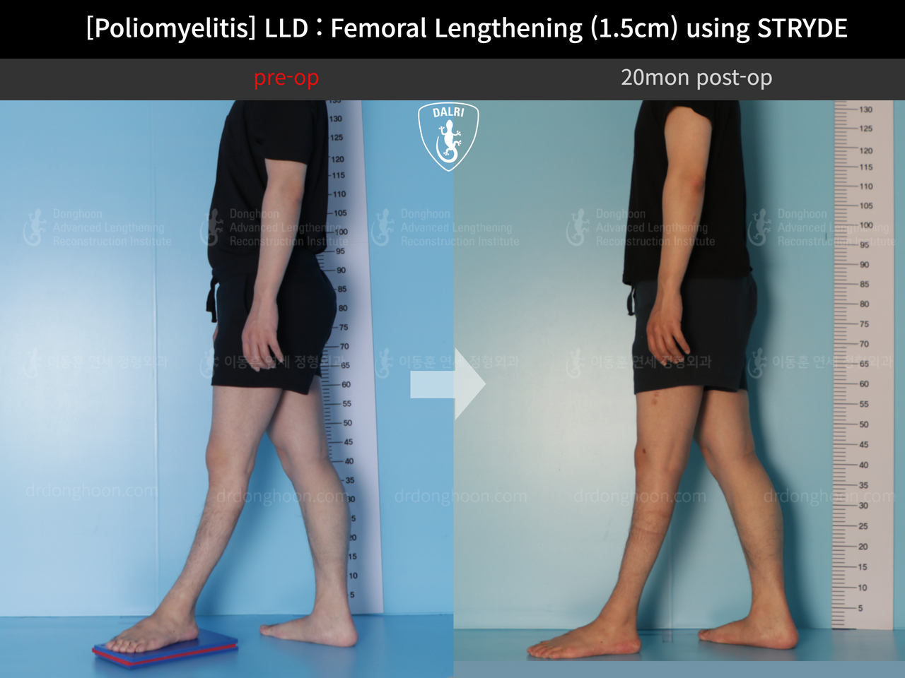 [Poliomyelitis] LLD : Femoral Lengthening (1.5cm) using STRYDE ...