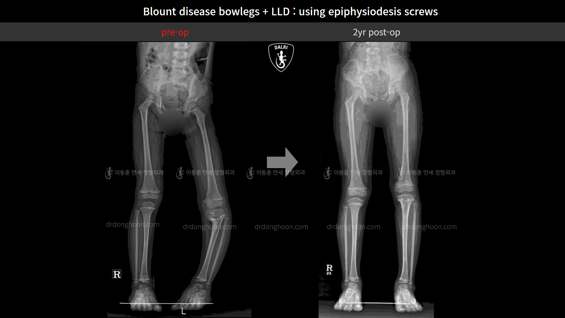 Blount disease bowlegs + LLD : using epiphysiodesis screws : Pediatric ...