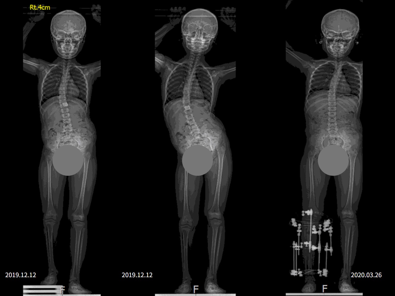 Pediatric Leg Length Discrepancy : Pediatric , Adolescent LLD