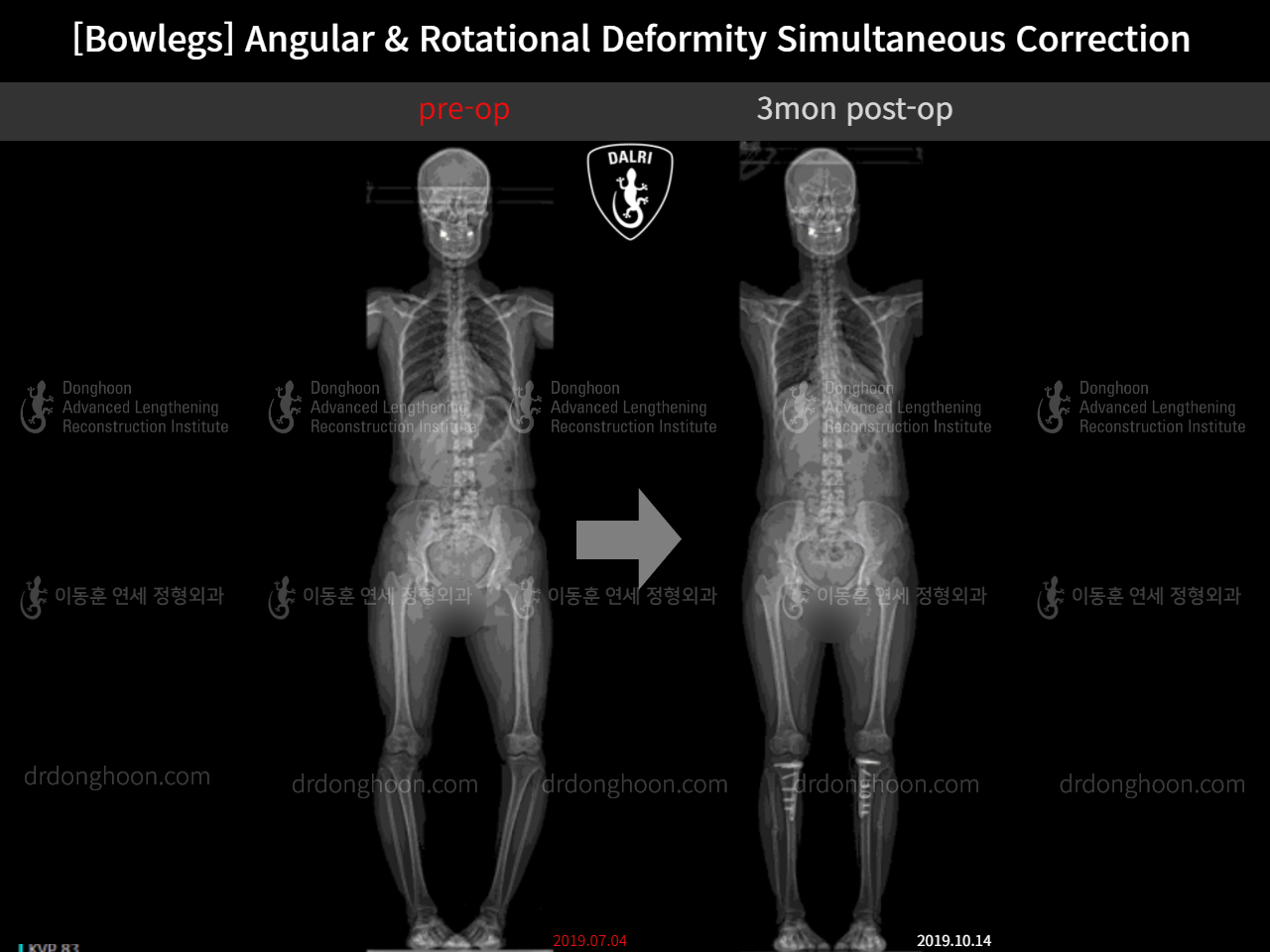 [Bowlegs] Angular & Rotational Deformity Simultaneous Correction ...