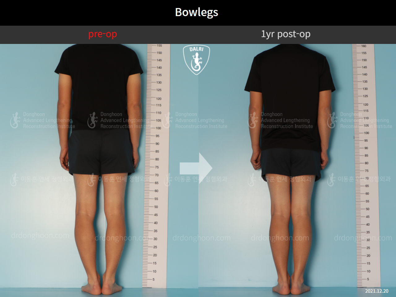 Bowlegs : Adult Bowlegs