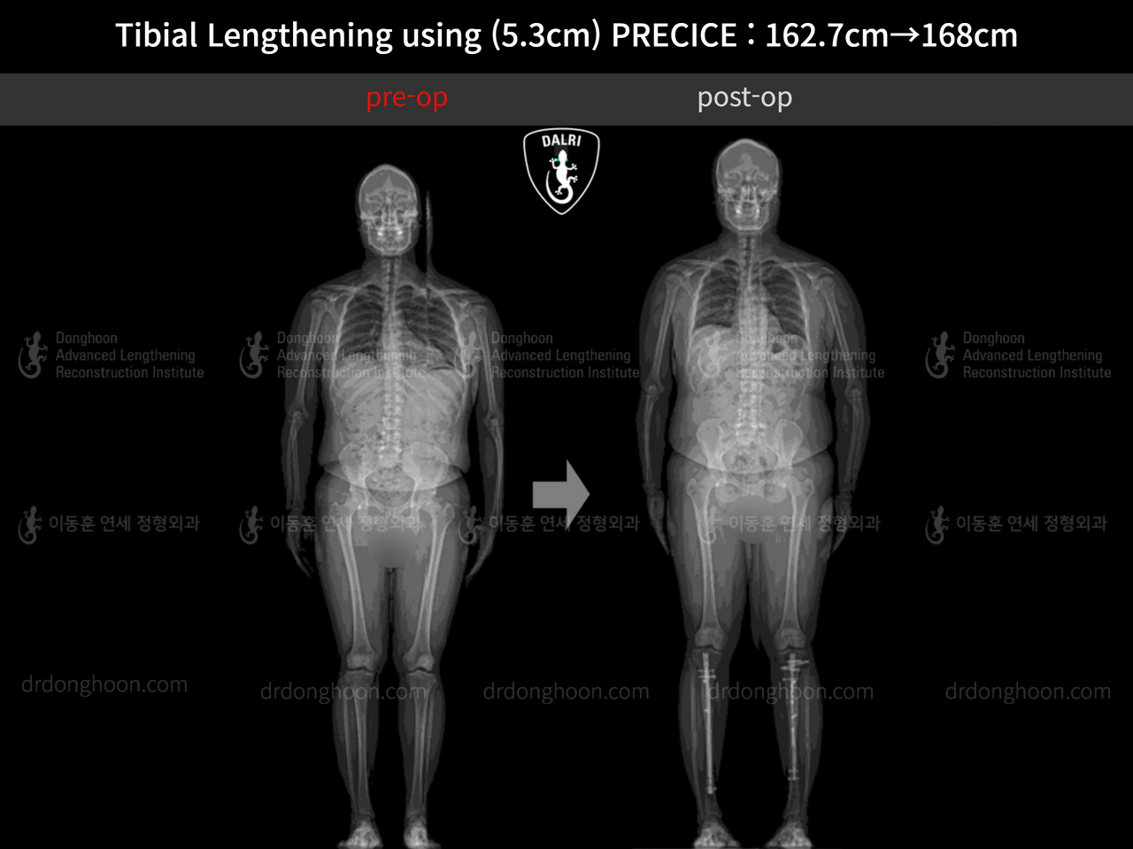 Tibial Lengthening using (5.3cm) PRECICE : 162.7cm→168cm : CLL PRECICE
