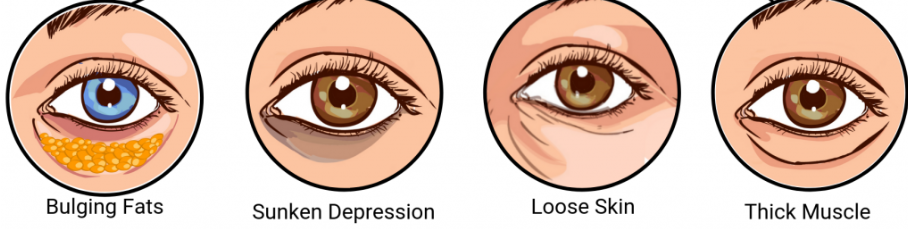 Everything to know about Eye Bag Solutions : Medi-fella | Blog