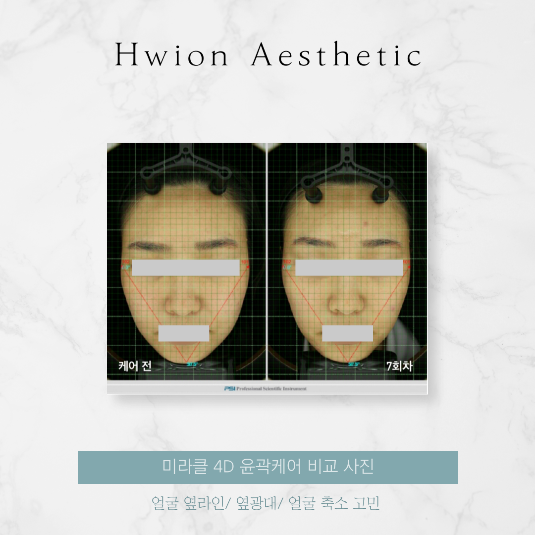 [OUTLINE] 미라클4D 얼굴 옆라인/ 옆광대/ 축소 고민 : HWION