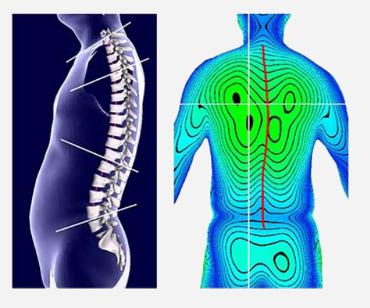 PMT Innovation | 3D Body Scanner | Posture analysis