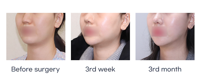 [Girin Plastic Surgery] - From Square Jaw to Chin Tip in One Go! The ...