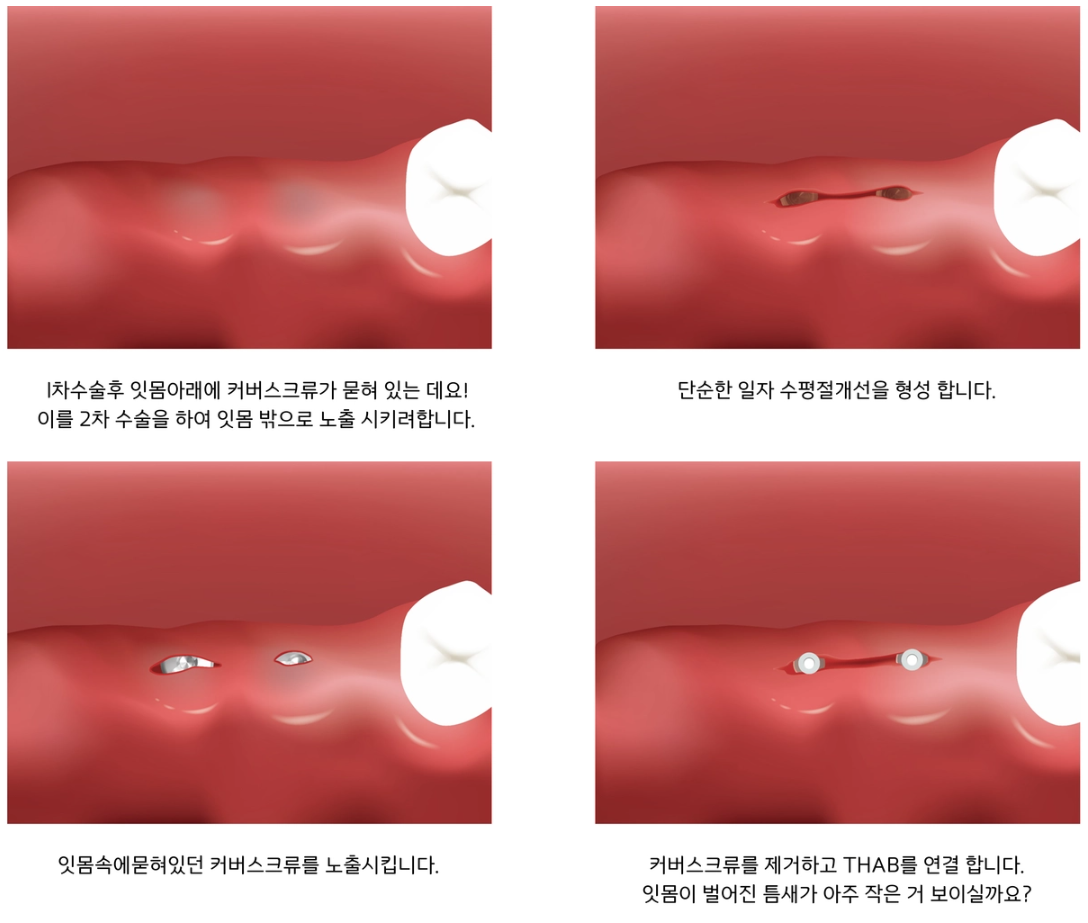 THAB Gide Set : 알파베러