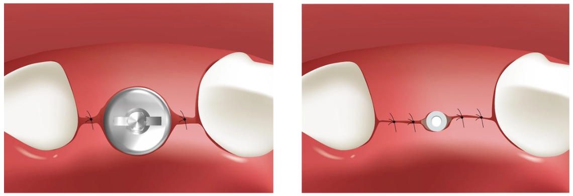 THAB Gide Set : 알파베러