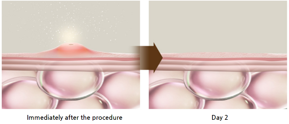 Faster Boosting: FillRoad | Skin Booster | PPEUM.Global : PPEUM.Global Introduces All-Inclusive ...