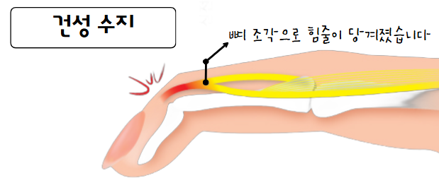 손가락 끝 관절이 구부려지셨나요? 망치수지의 진단 : 남양주정형외과 진접정형외과 의학정보칼럼