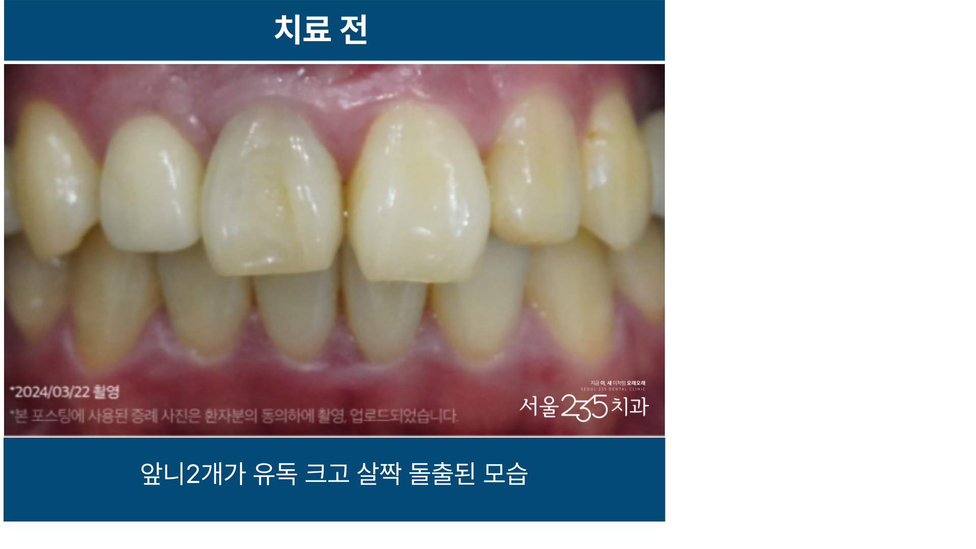 토끼이빨 최소삭제라미네이트 치료사례 남양주치과 서울235치과 원장님 치아이야기